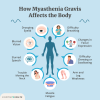 7 Must-Know Facts About Myasthenia Gravis And Mobility